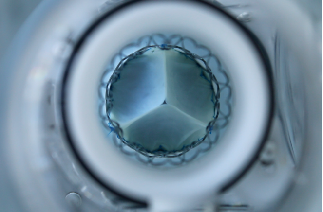 A prosthetic heart valve for adults and children, made from the patient ...