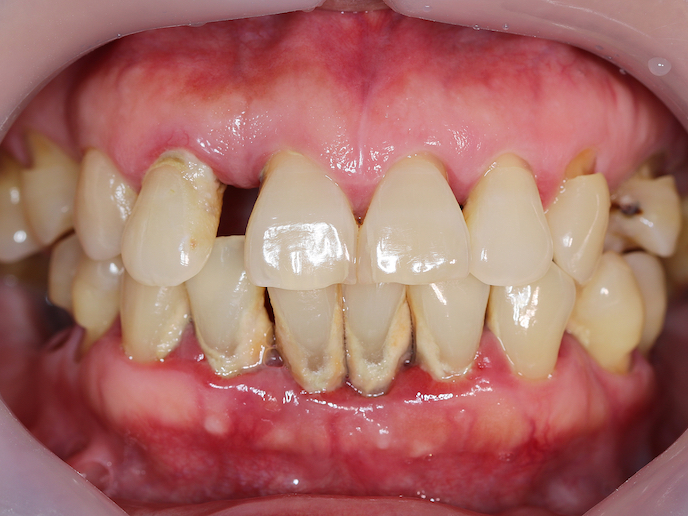 The Important Role That The Epstein Barr Virus Plays In Periodontitis The Important Role That The Epstein Barr Virus Plays In Periodontitis